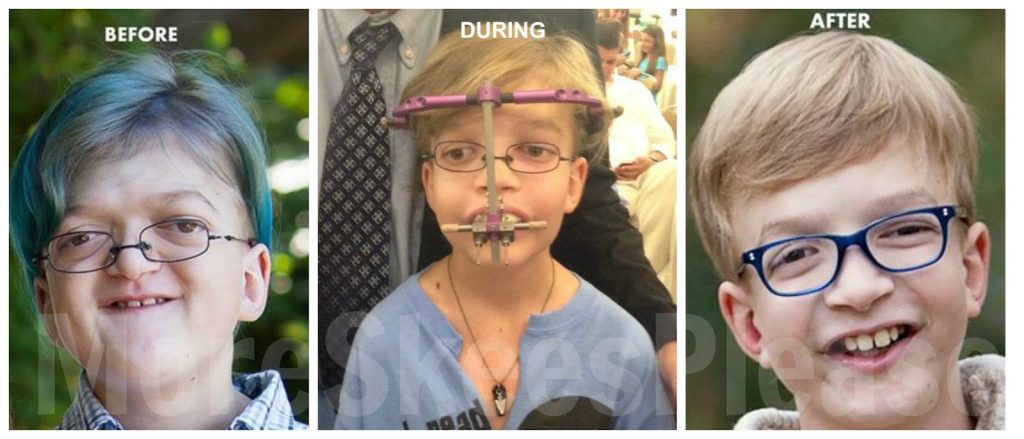 متلازمة كورنيليا دي لانج – مجموعة الدعم الأسري لمتلازمات الوراثية و الخلقية